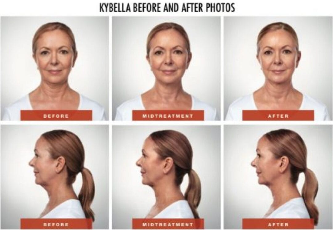 Kybella Treatment In Alpharetta, GA | Allure MedSpa